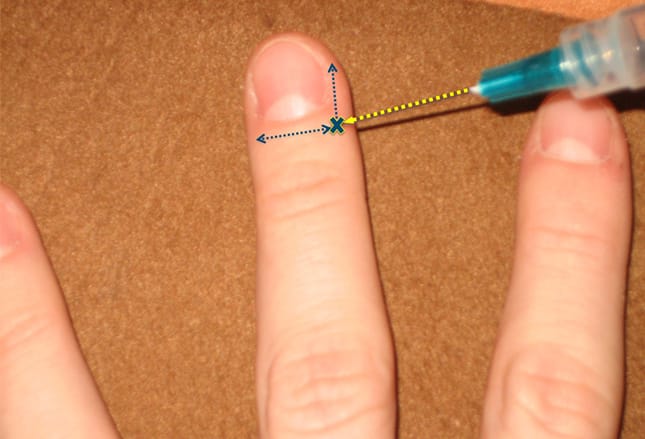 Regionale Anästhesie: Mit diesen Tricks gelingt die Betäubung an allen ...