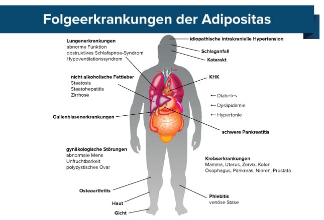 Übergewicht weltweit: Was tun gegen eine neue Art von Epidemie?
