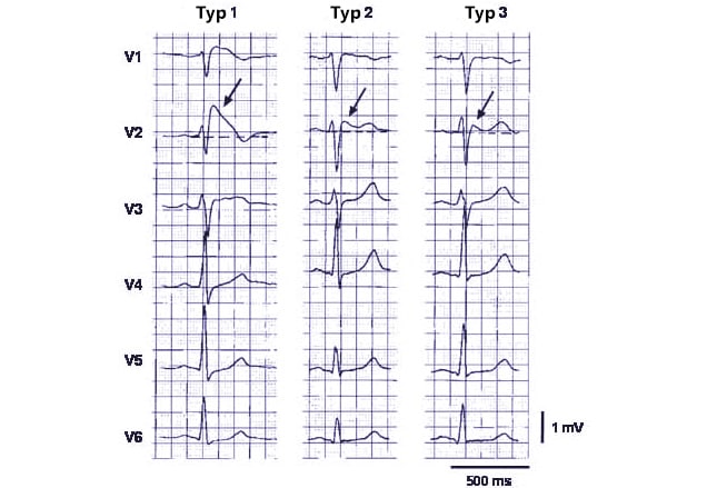 Torsade de Pointes Tachykardie: Das richtige Vorgehen von Diagnose bis ...