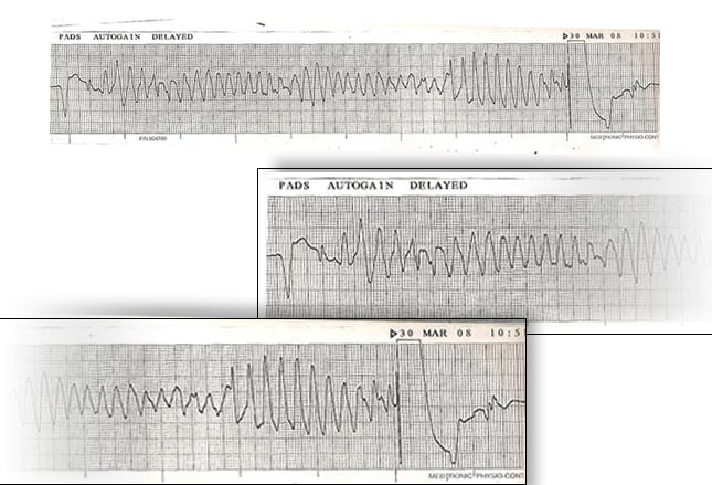 Torsade de Pointes Tachykardie: Das richtige Vorgehen von Diagnose bis ...