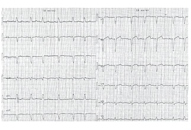 Torsade de Pointes Tachykardie: Das richtige Vorgehen von Diagnose bis ...