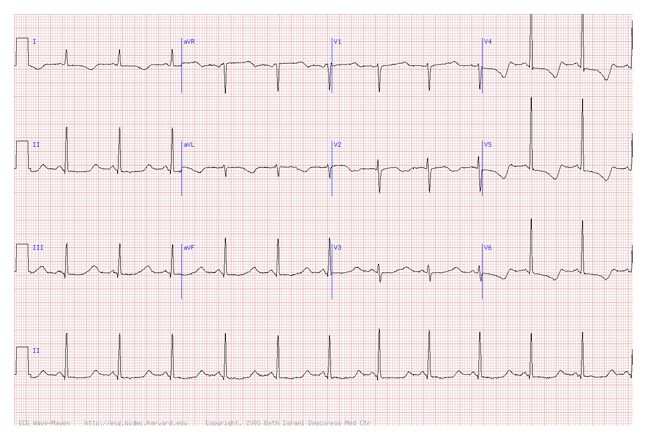 Torsade de Pointes Tachykardie: Das richtige Vorgehen von Diagnose bis ...