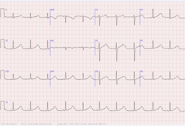 Torsade de Pointes Tachykardie: Das richtige Vorgehen von Diagnose bis ...