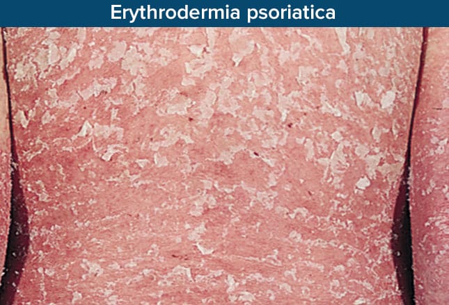 Psoriasis: Formen, Behandlung und Differenzialdiagnostik