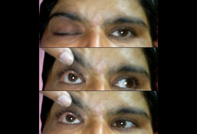 Hinweise im Auge: 11 opthalmologische Befunde, die Neurologen bei der ...