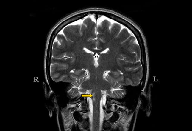 Hinweise im Auge: 11 opthalmologische Befunde, die Neurologen bei der ...