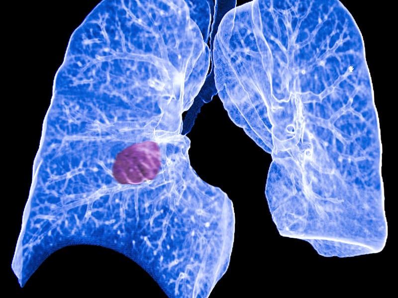 Bronchialkarzinom: Längeres Überleben mit Atezolizumab