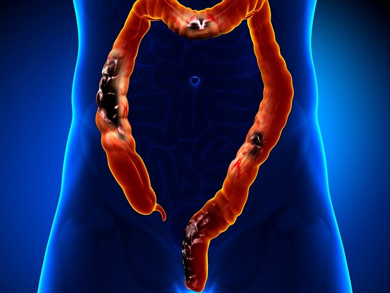 Darmkrebs: Einmalige Sigmoidoskopie senkt Risiko über 17 Jahre