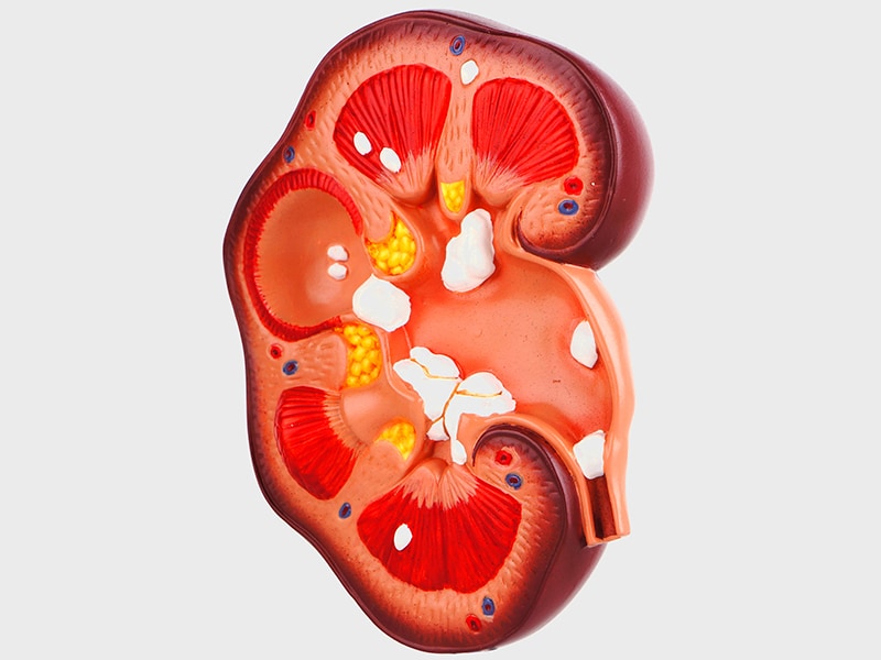 Harnsteine bei Kindern: Tipps zu Diagnose und Therapie