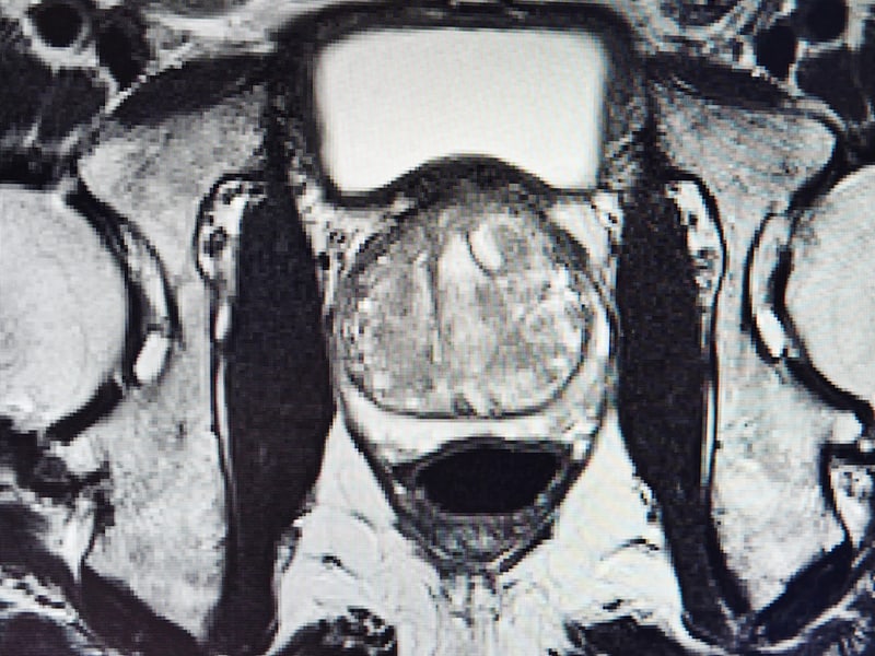 Prostatakarzinom: Radiotracer für Diagnostik und Therapie