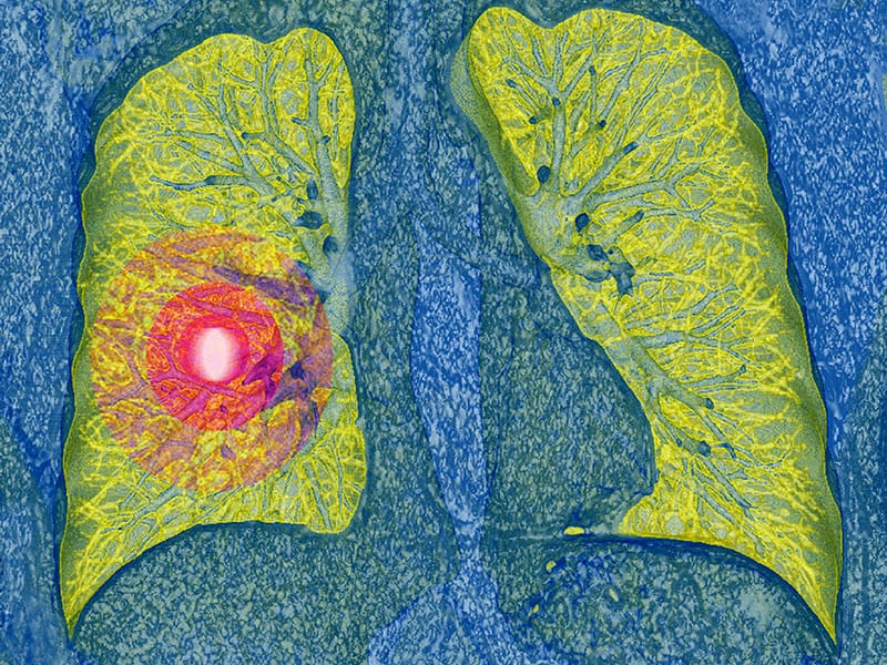 Bronchialkarzinom: Mit PD-L1-Hemmer und Chemo länger leben