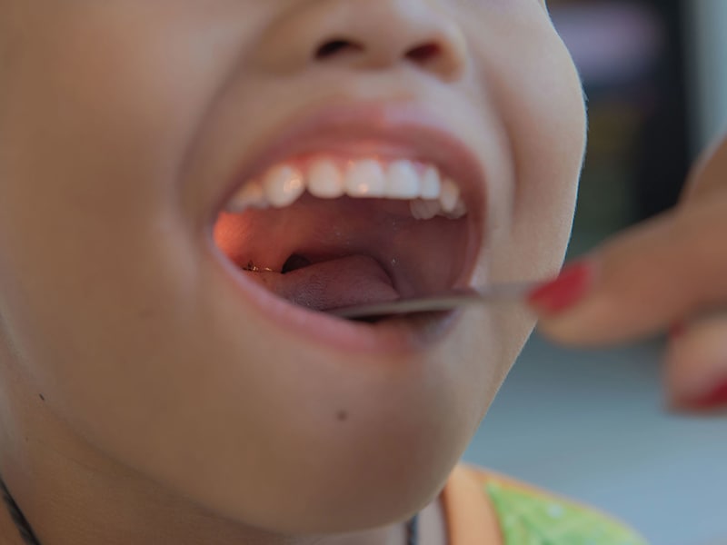 Birgt die Mandel-OP ein langfristiges Krankheitsrisiko?