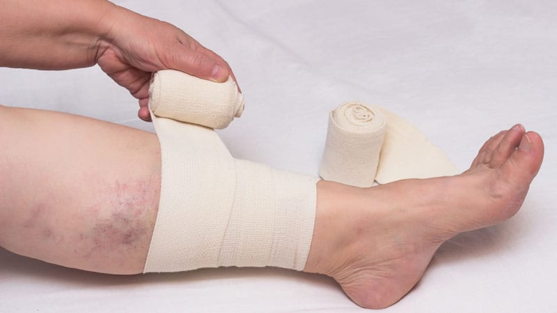Varizen: Produziert der Laser tatsächlich viel mehr Rezidive als die OP?