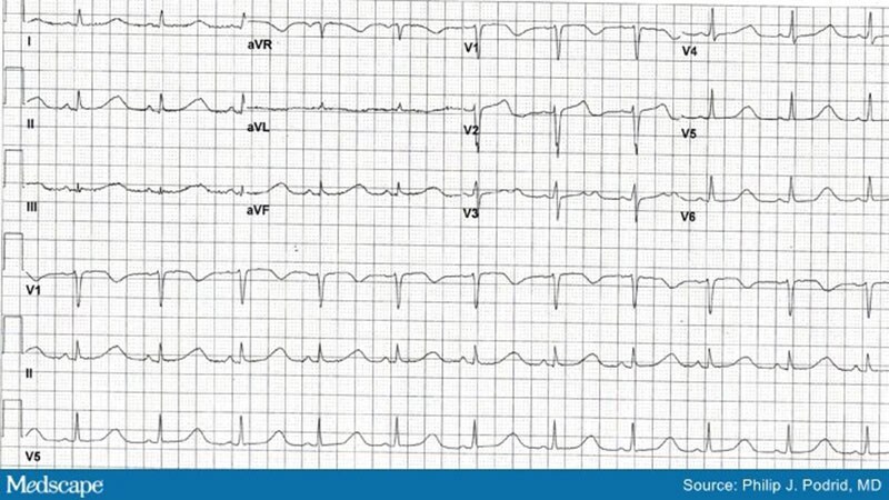 EKG-Quiz: Postoperative Krämpfe und Spasmen bei Tumorpatient