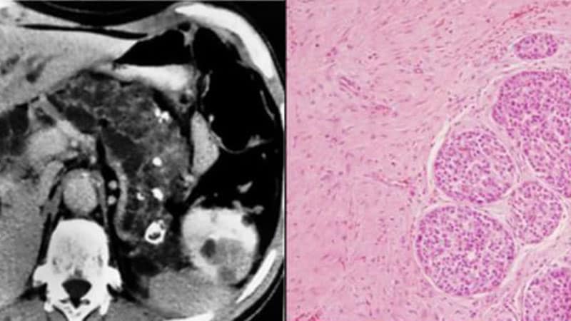 Fall: Eine 15-Jährige mit Steatorrhö und Nachtblindheit – Ihr Verdacht ...