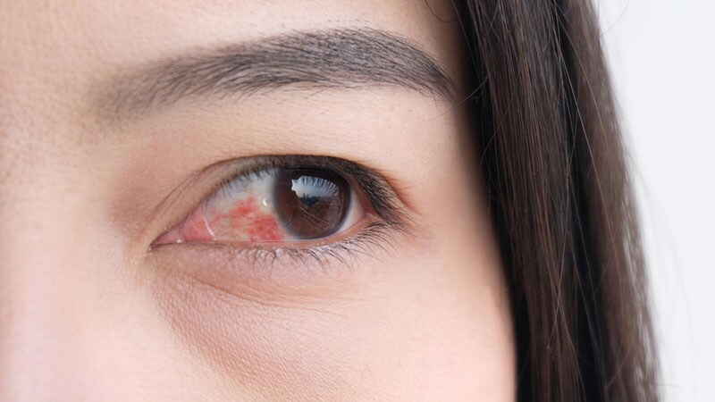 Rote Augen: Wann Banalität, wann Alarmsignal? Top Ten der Ursachen