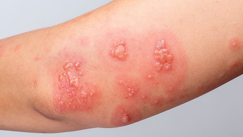 Quiz: Herpes zoster – Dichtung und Wahrheit. Kennen Sie die Fakten ...