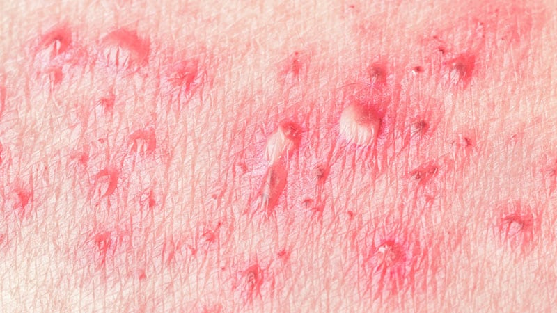 Post-Zoster-Neuralgie: Wie vorbeugen, wie behandeln?