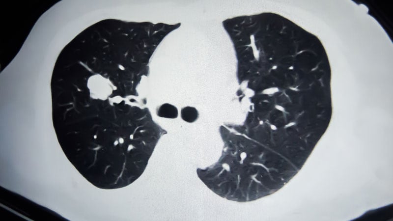 Kommt das Low-dose-CT als Lungenkrebs-Screening?