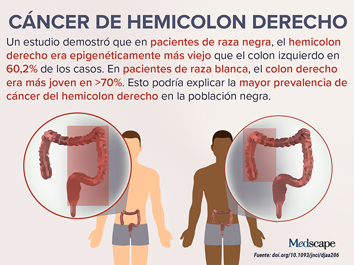 Tendencia clínica: Cáncer de hemicolon derecho