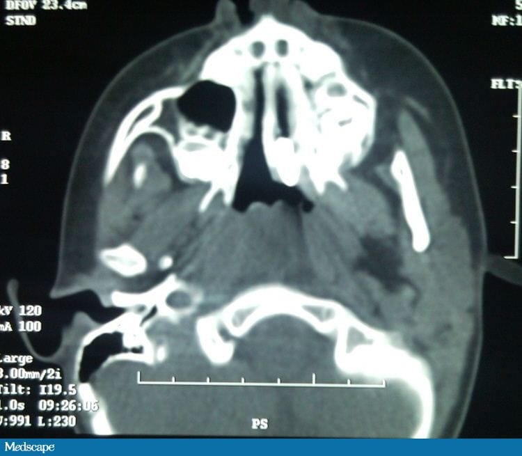 Una niña con dificultades respiratorias y secreción nasal - Page 2