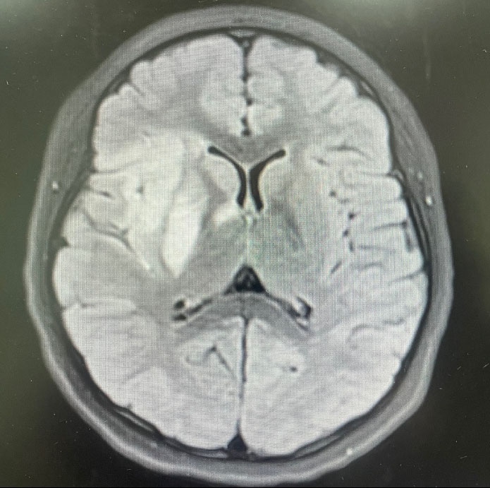 5 minutos de pediatría: Paciente con cefalea holocraneana y parálisis ...