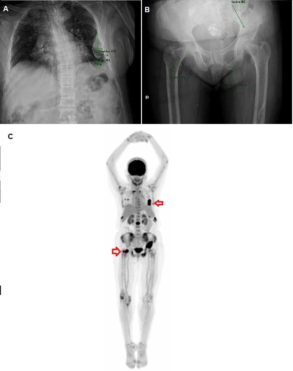 5 minutos de endocrinología: Paciente femenina con lesiones óseas