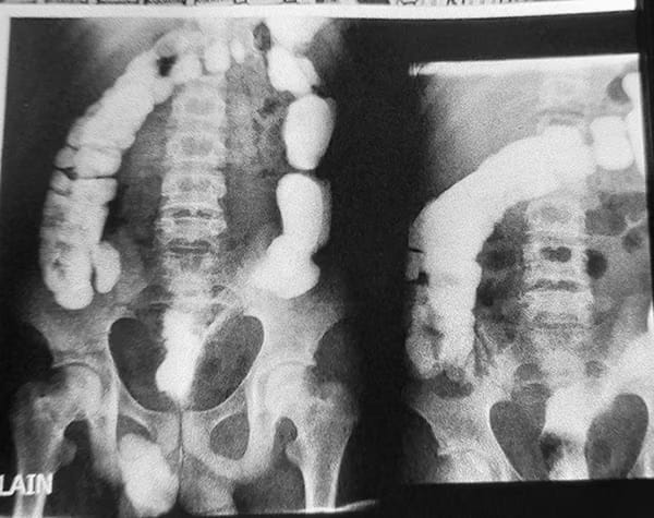 Caso clínico: Distensión colónica grave en un paciente con síndrome de ...