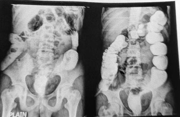 Caso clínico: Distensión colónica grave en un paciente con síndrome de ...