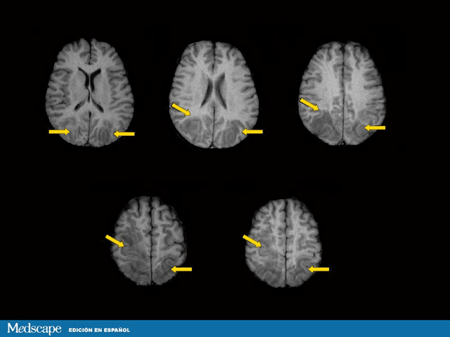 Caso Clínico: Agnosia visual en una mujer previamente sana - Page 2