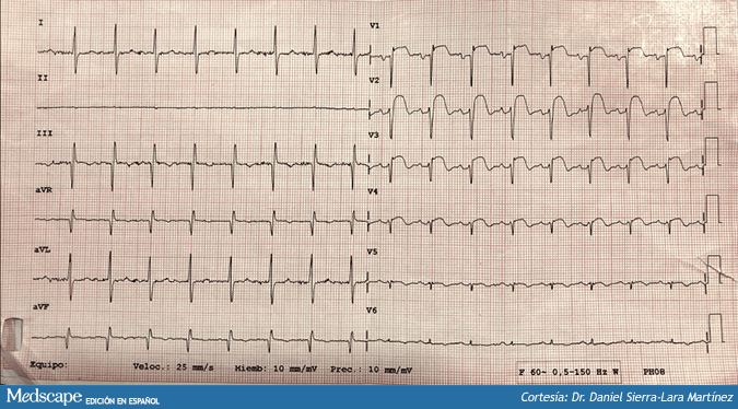 Infarto del ventrículo derecho: lo que hay que saber