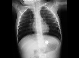 Mini Examen Clínico: ¿Está preparado para tratar cuerpos extraños? - Page 3