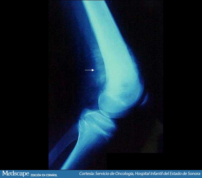 Mini Examen Clínico: Evalúe sus conocimientos sobre osteosarcoma - Page 4