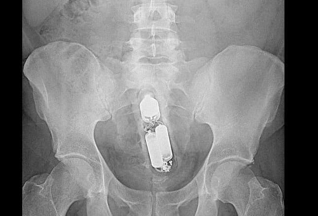 Cuerpos extraños: hallazgos curiosos