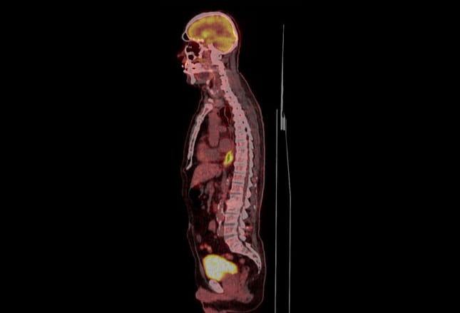 Cáncer de esófago: devastador y mortal