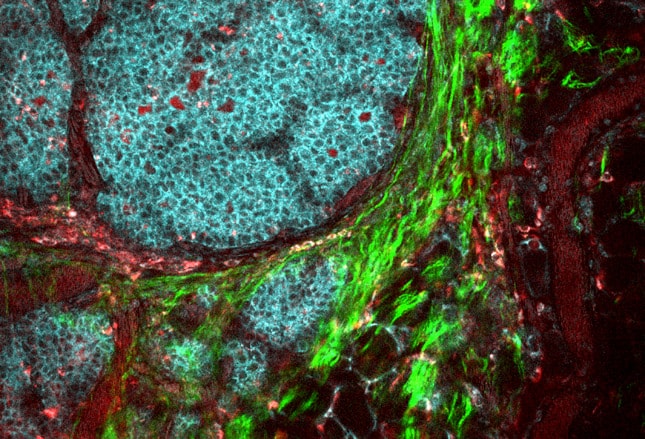20 impresionantes imágenes de células cancerosas mediante microscopia ...