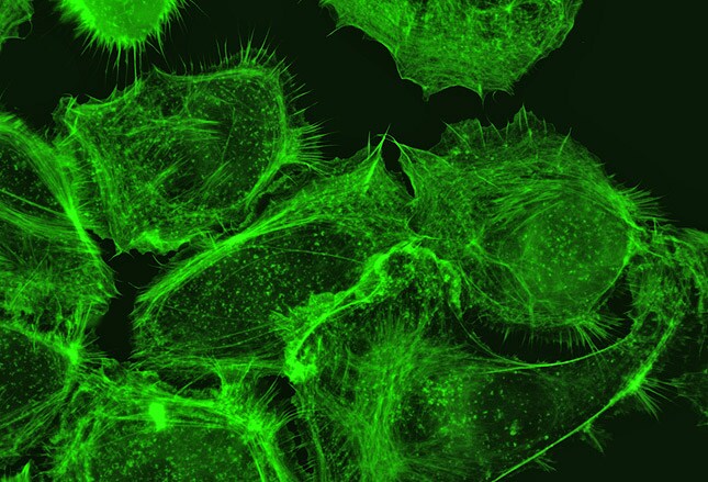 20 impresionantes imágenes de células cancerosas mediante microscopia ...