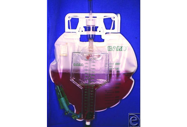 11 causas de cambio de color de la orina