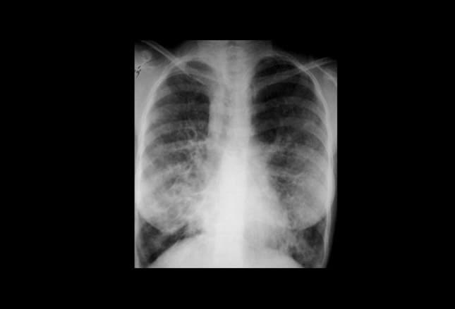 Revisión radiológica del tórax en la sala de urgencias