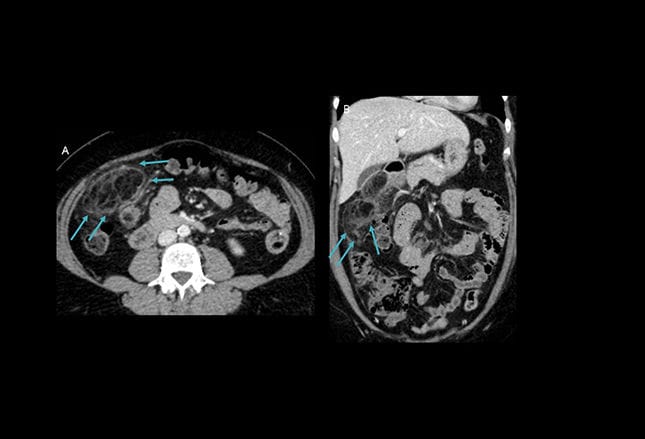 Diagnóstico por imagen del abdomen agudo: 20 causas no traumáticas