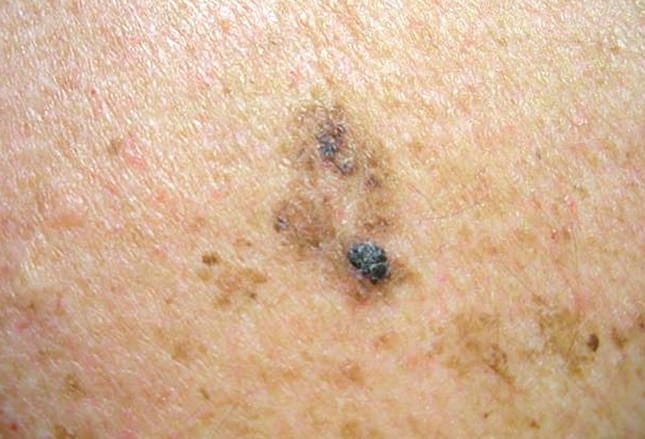 ¿Nevus o melanoma? Autoevalúese con estas lesiones sospechosas