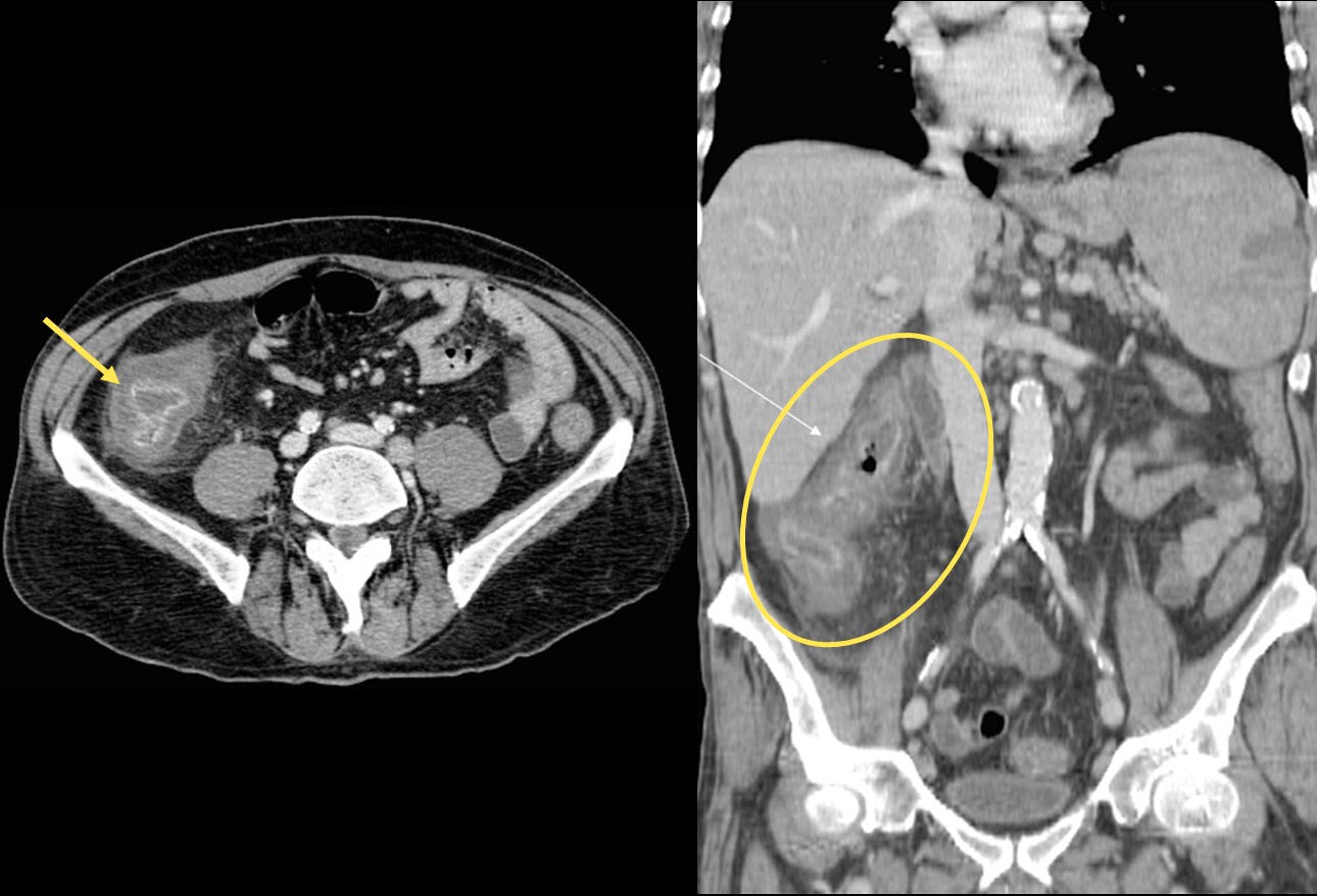 11 urgencias oncológicas que debe conocer