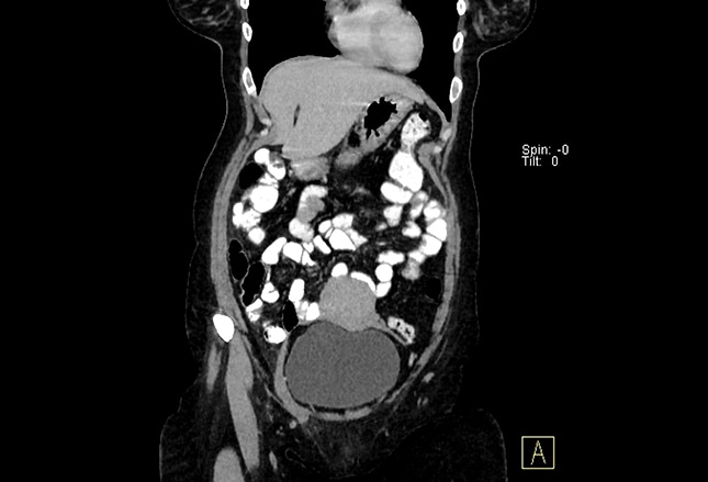 15 causas de dolor abdominal en el embarazo