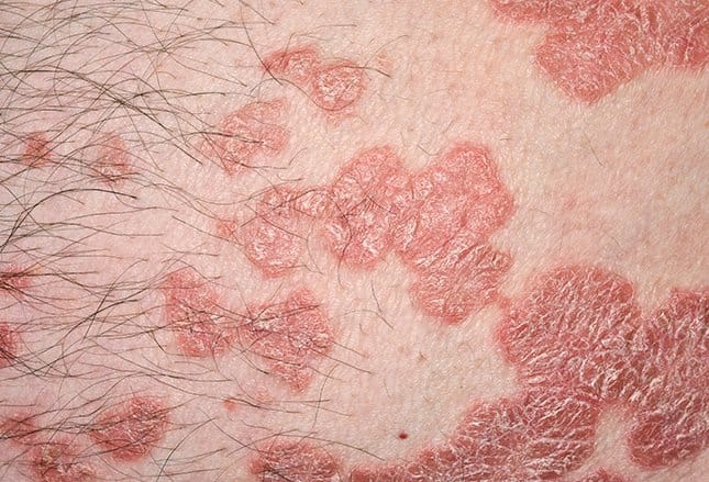 Psoriasis: manifestaciones, opciones de manejo y diagnósticos diferenciales