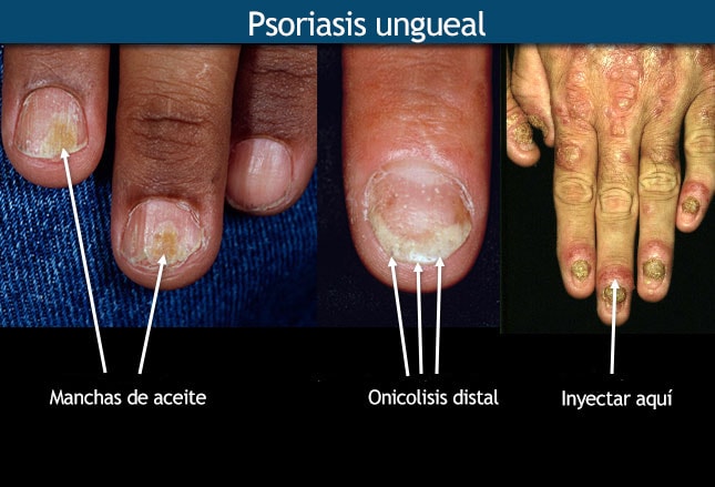 Psoriasis: manifestaciones, opciones de manejo y diagnósticos diferenciales
