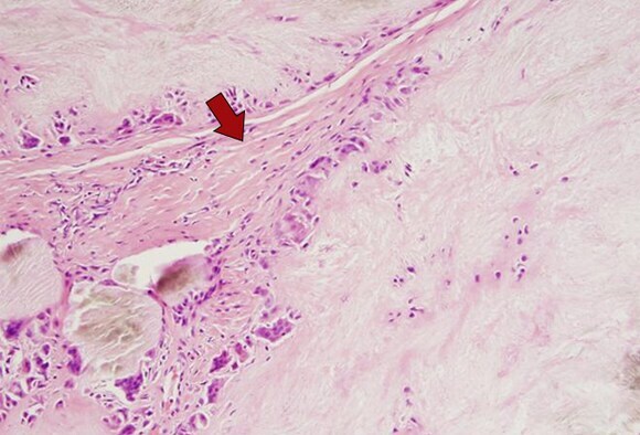 Es la temporada de gota