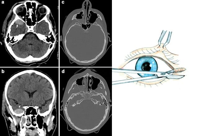 Traumatismo ocular: ocho lesiones oculares potencialmente devastadoras