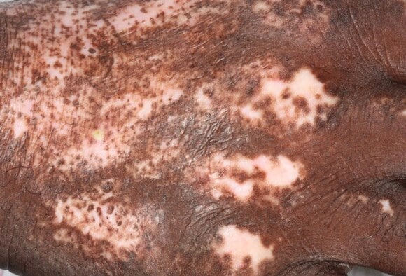 Lesiones en la piel de color: lo que hay que saber