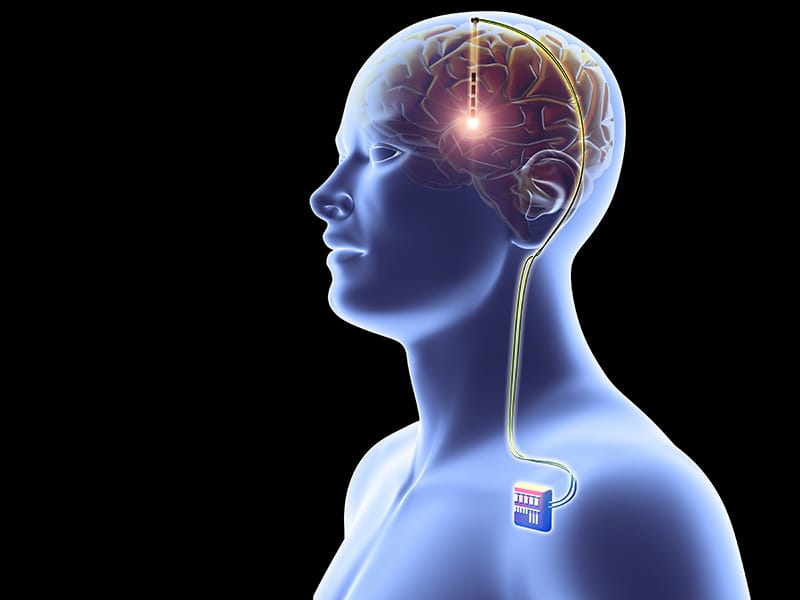 La estimulación cerebral profunda puede ayudar en el Alzheimer