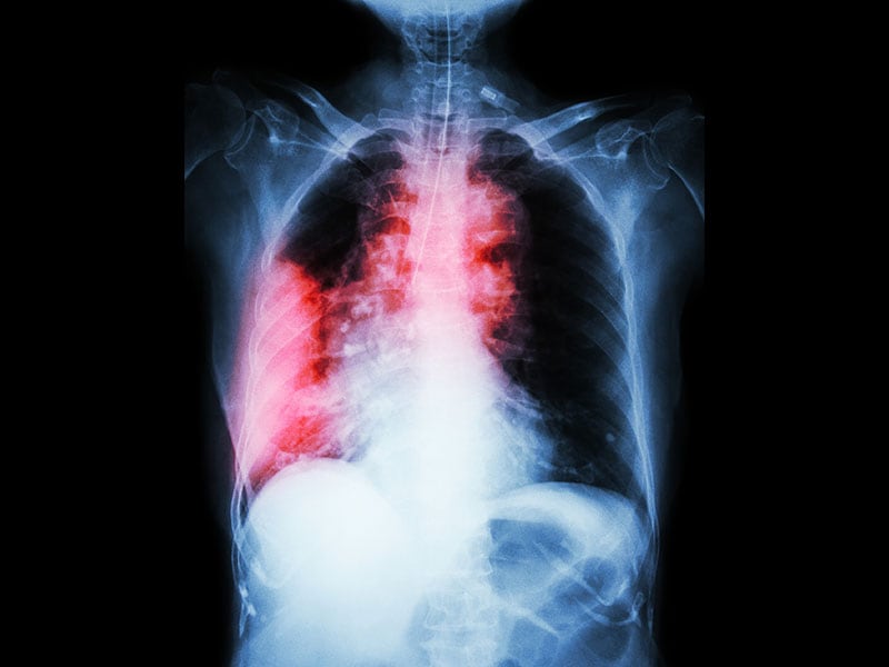 Diagnóstico y tratamiento del cáncer de pulmón